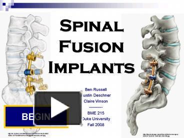 Spinal Fusion Implants presentation | free to view