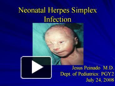 Neonatal Herpes Simplex Infection presentation | free to view