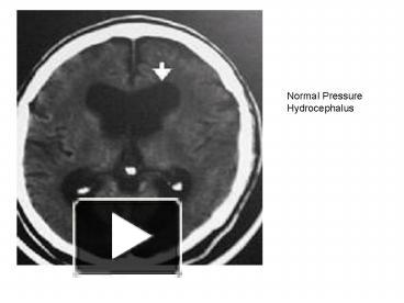 Normal Pressure Hydrocephalus presentation | free to view