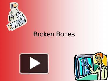 Broken Bones presentation | free to view