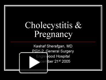 Cholecystitis presentation | free to view