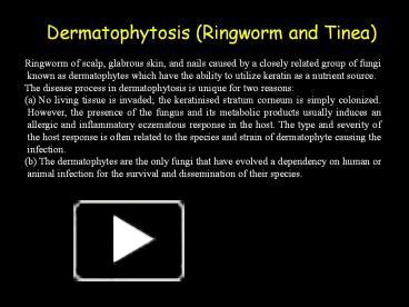 Dermatophytosis (Ringworm and Tinea) presentation | free to view