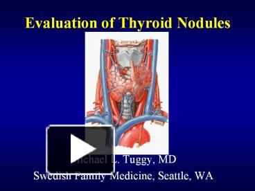 Evaluation of Thyroid Nodules presentation | free to view