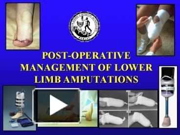 POST-OPERATIVE MANAGEMENT OF LOWER LIMB AMPUTATIONS presentation | free to view