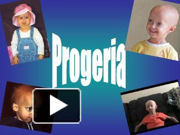 Progeria presentation | free to download