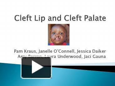 Cleft Lip and Cleft Palate presentation | free to view