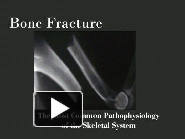 PPT – Bone Fracture PowerPoint presentation | free to view - id: 44b7e5 ...