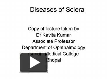 Diseases of Sclera presentation | free to view