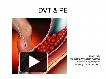 DVT presentation | free to view