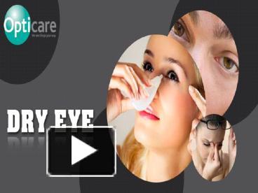 Dry Eye presentation | free to download