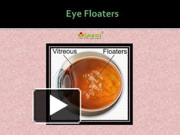PPT – Eye floaters: An overview of symptoms, causes and treatment (1 ...