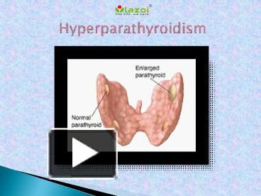 PPT – Hyperparathyroidism: Symptoms, causes and treatment (1) PowerPoint presentation | free to ...