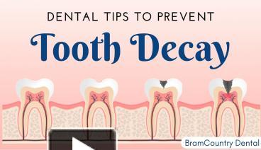 PPT – Dental Tips to Prevent Tooth Decay by the Dentist in Brampton PowerPoint presentation ...