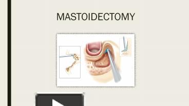 Mastoidectomy - Meddco presentation | free to download