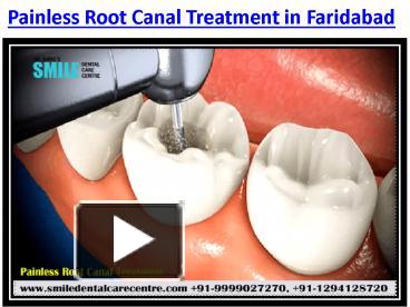 PPT – Painless Root Canal Treatment in Affordable Prices at Faridabad PowerPoint presentation ...