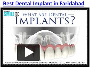 PPT – To Get Painless Root Canal Treatment Best Dental Clinic in Faridabad PowerPoint ...