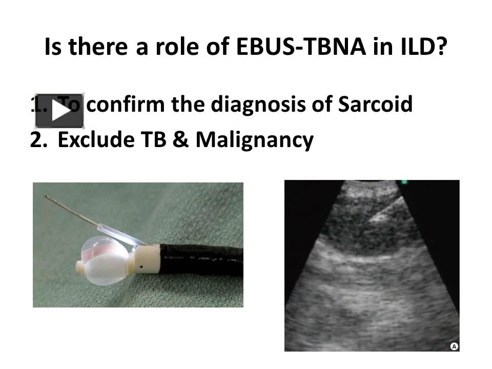 PPT – Is there a role of EBUS-TBNA in ILD Part 7 Dr. Sheetu singh PowerPoint presentation | free ...