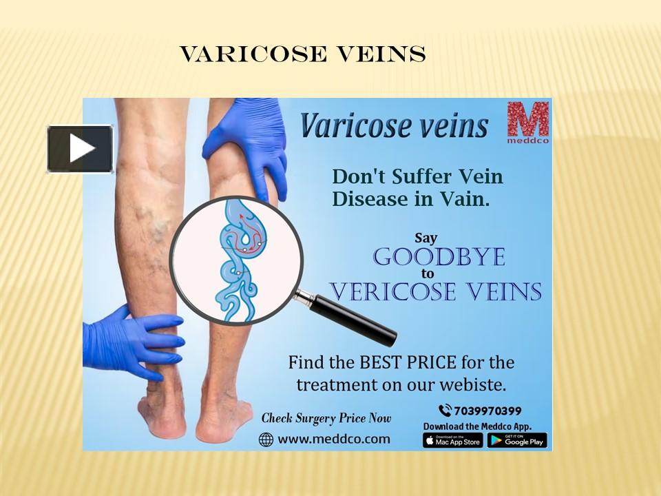 Varicose Veins presentation | free to download
