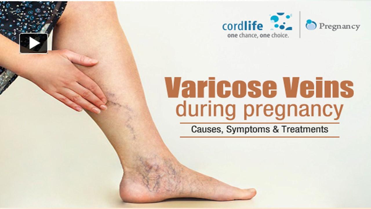 Varicose Veins During Pregnancy – Causes, Symptoms & Treatments presentation | free to download