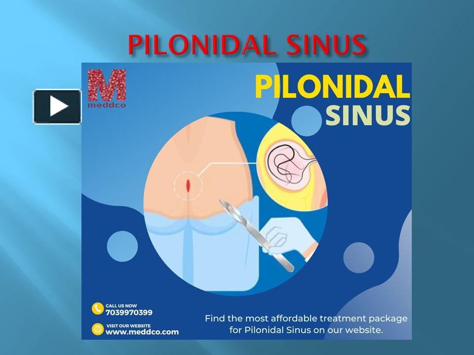 PPT – Pilonidal Sinus PowerPoint presentation | free to download - id: 958ca7-Mzg1M