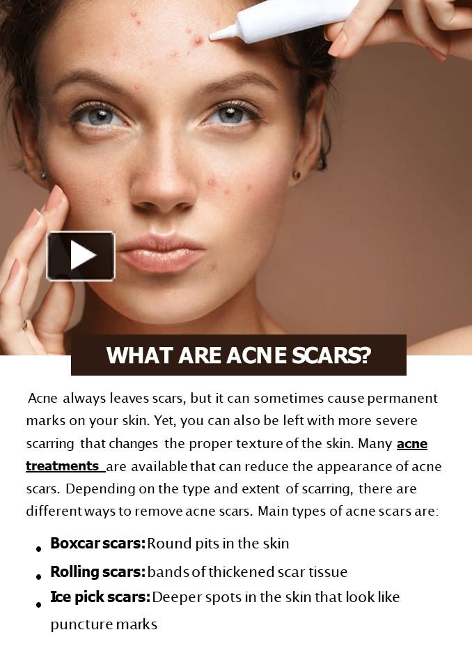 WHAT ARE ACNE SCARS? presentation | free to download