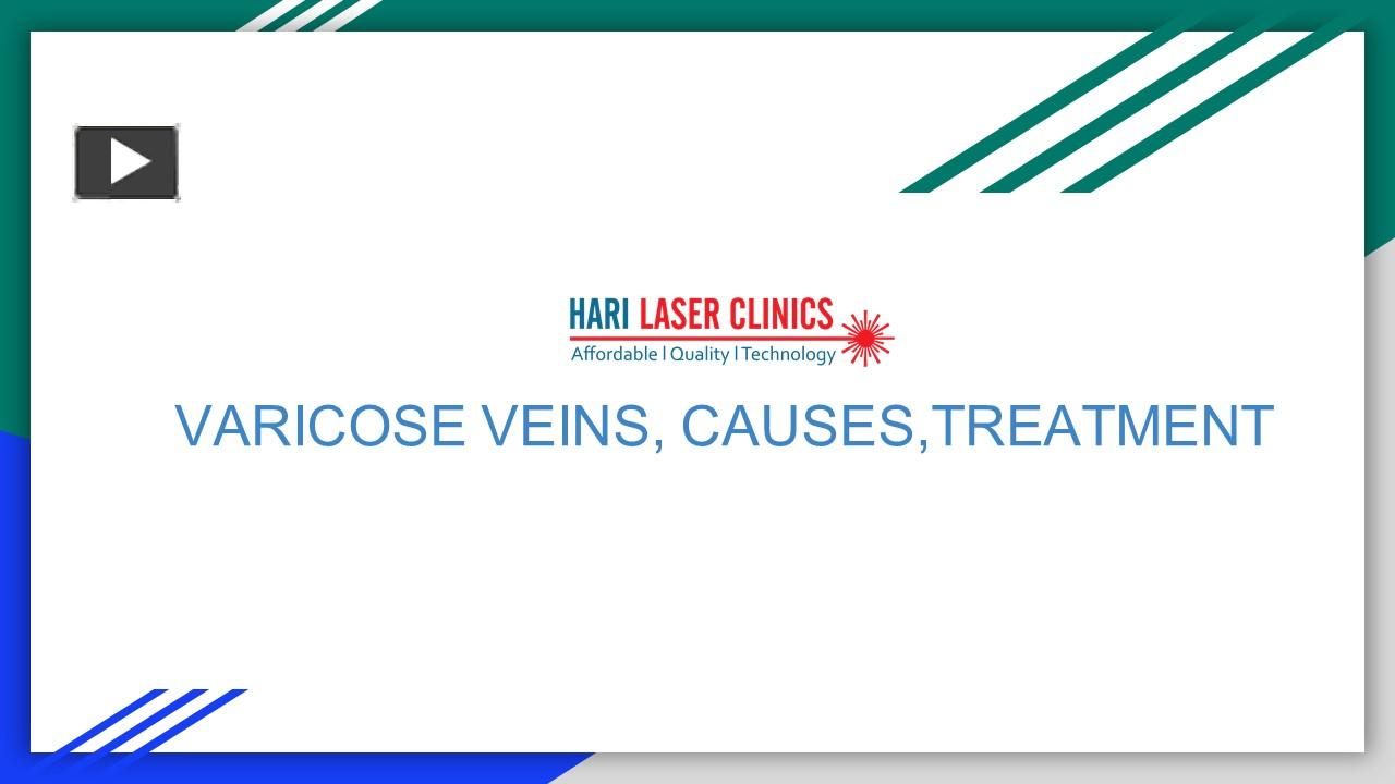 varicose veins, causes , treatment presentation | free to download