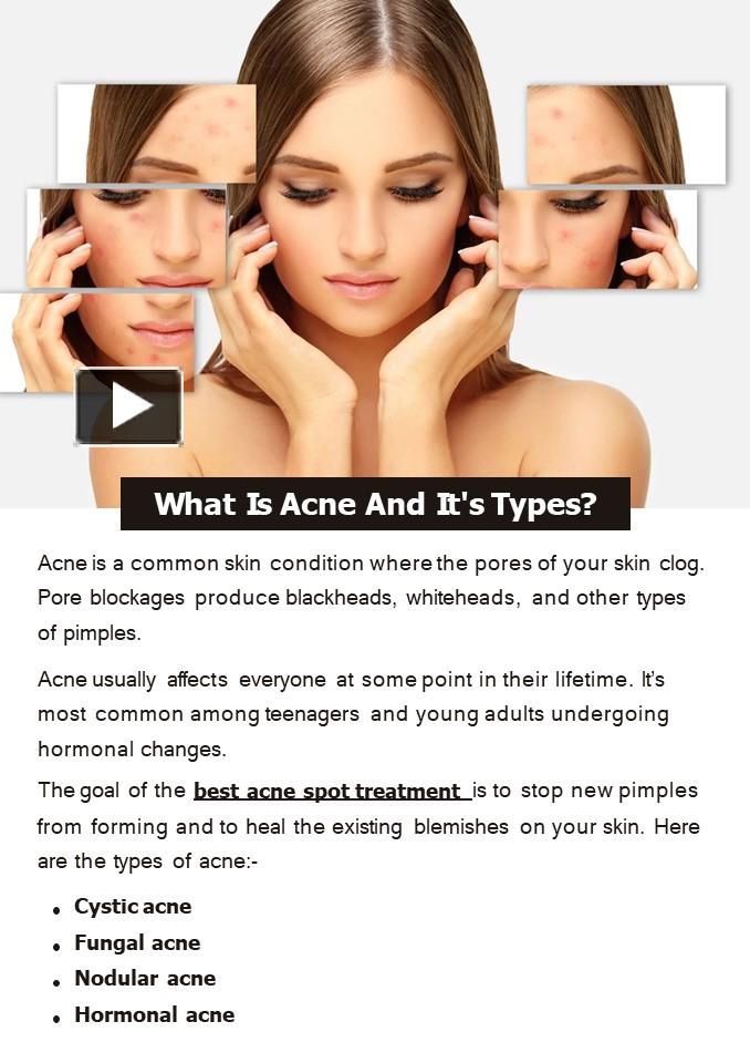 PPT – What Is Acne And It's Types? PowerPoint presentation | free to ...