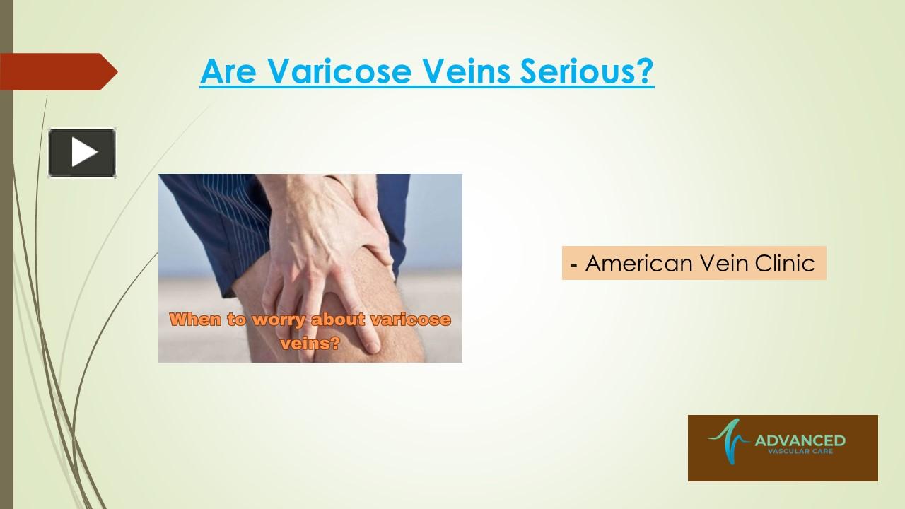 PPT – Are Varicose Veins Serious? PowerPoint presentation | free to download - id: 96aa69-NjJlO
