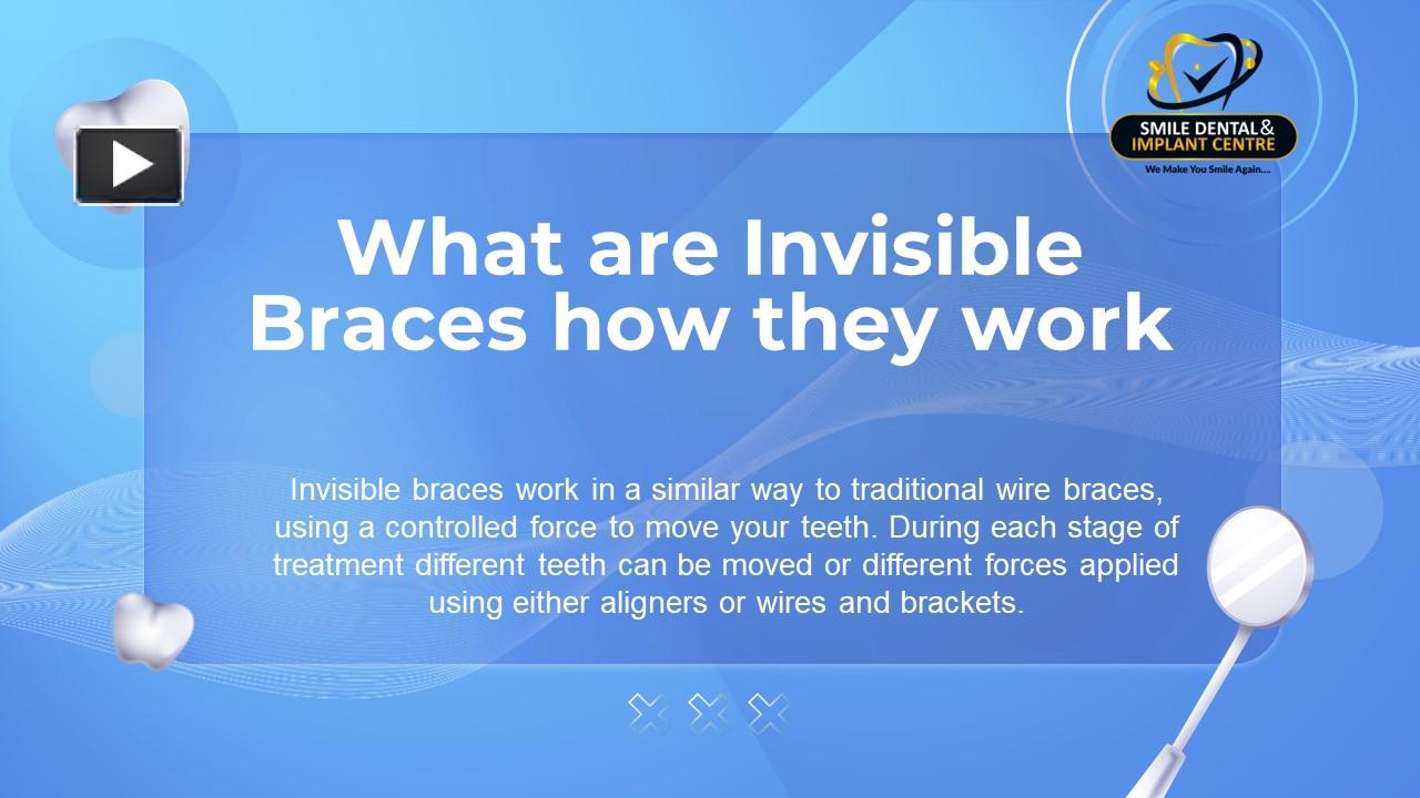PPT – What are Invisible Braces How They Work | Smile Dental and Implant Centre PowerPoint ...