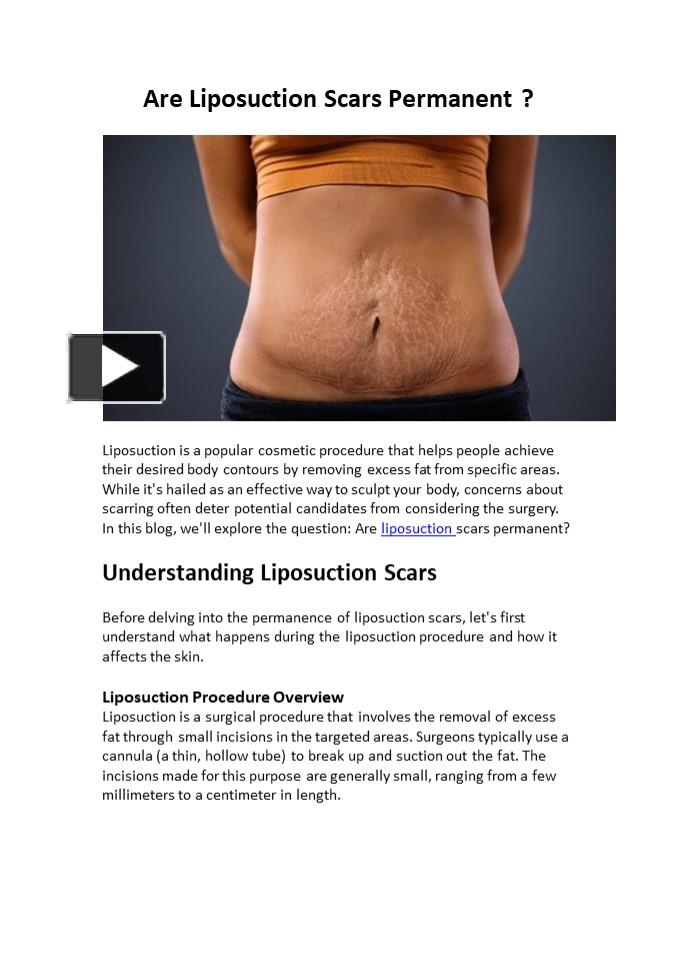 Are Liposuction Scars Permanent? presentation | free to download