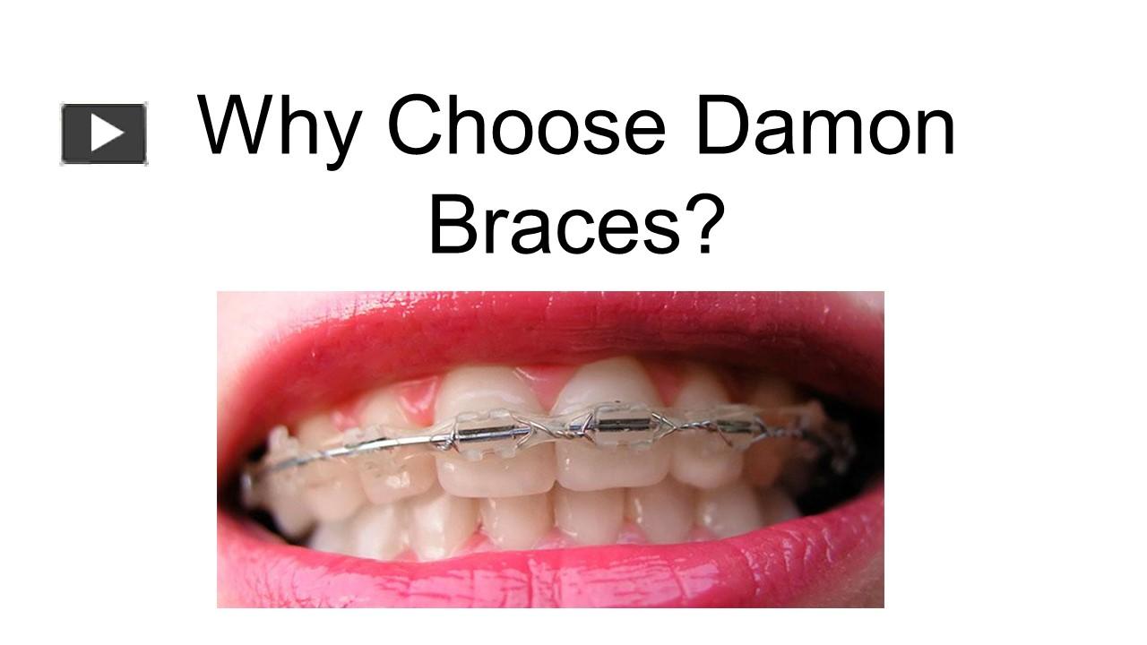 PPT – Why Choose Damon Braces? PowerPoint presentation | free to download - id: 97f795-YWQ2Z