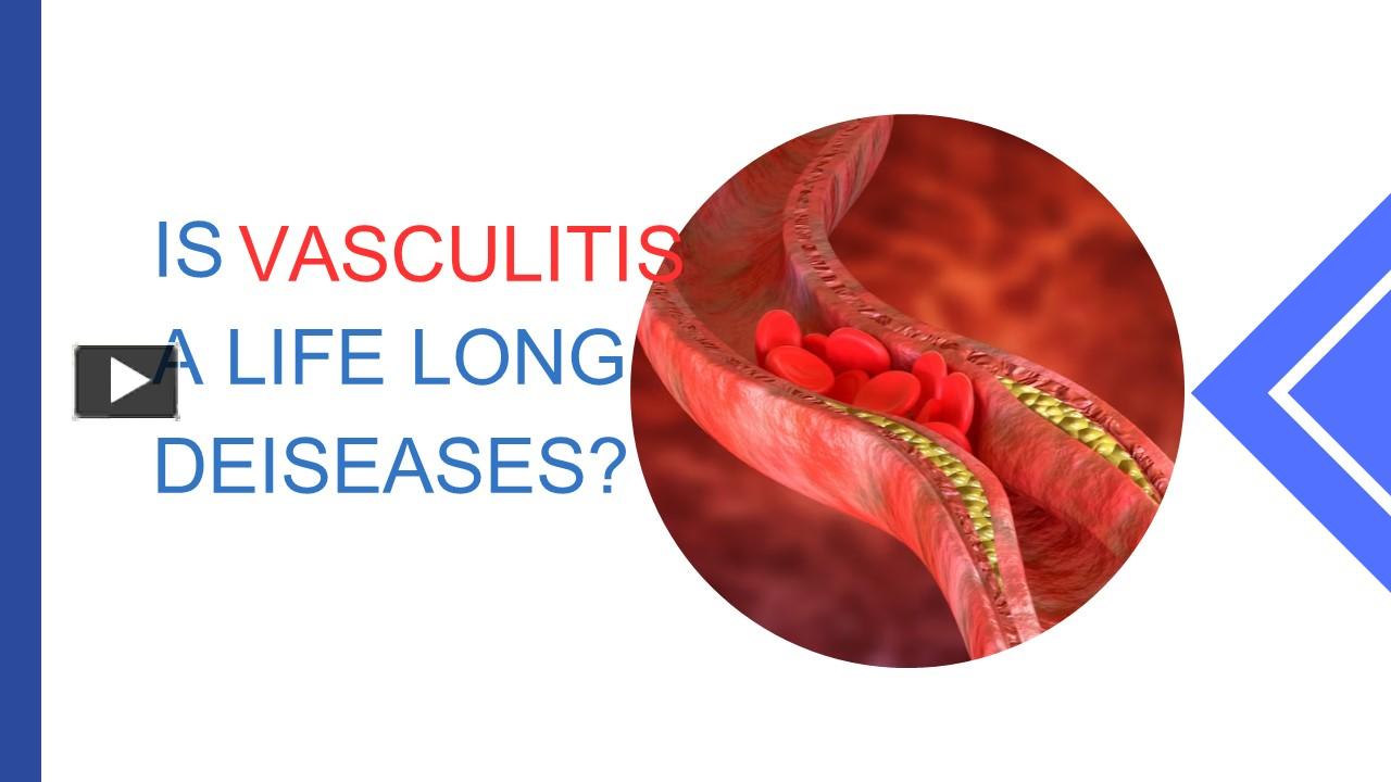 Is vasculitis a life long diseases ? presentation | free to download