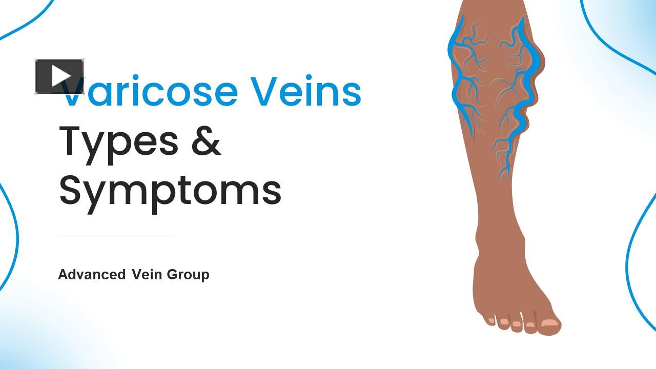 PPT – Varicose Veins Types & Symptoms PowerPoint presentation | free to download - id: 981f17-OTVjM