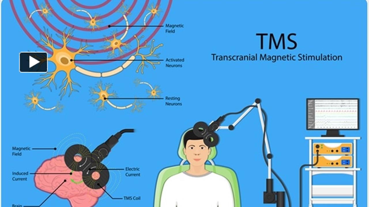 PPT – Accelerated TMS: Moving Quickly into the Future of Depression Treatment PowerPoint ...