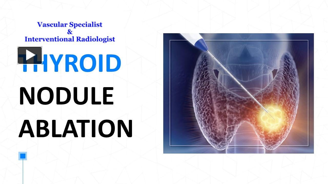 Thyroid Nodule Ablation presentation | free to download