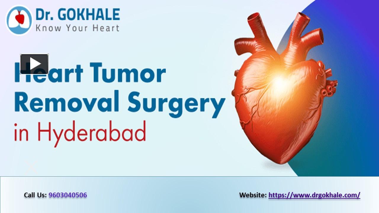 Ppt Heart Tumor Removal Surgery In Hyderabad Dr Gokhale Powerpoint