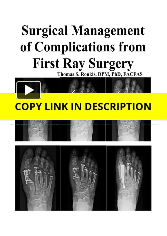 PPT – [PDF] Surgical Management of Complications from First Ray Surgery Ipad PowerPoint ...