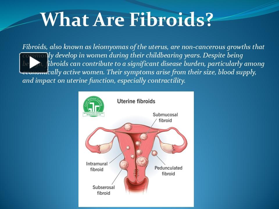 Uterrine Fibroid Embolization presentation | free to download