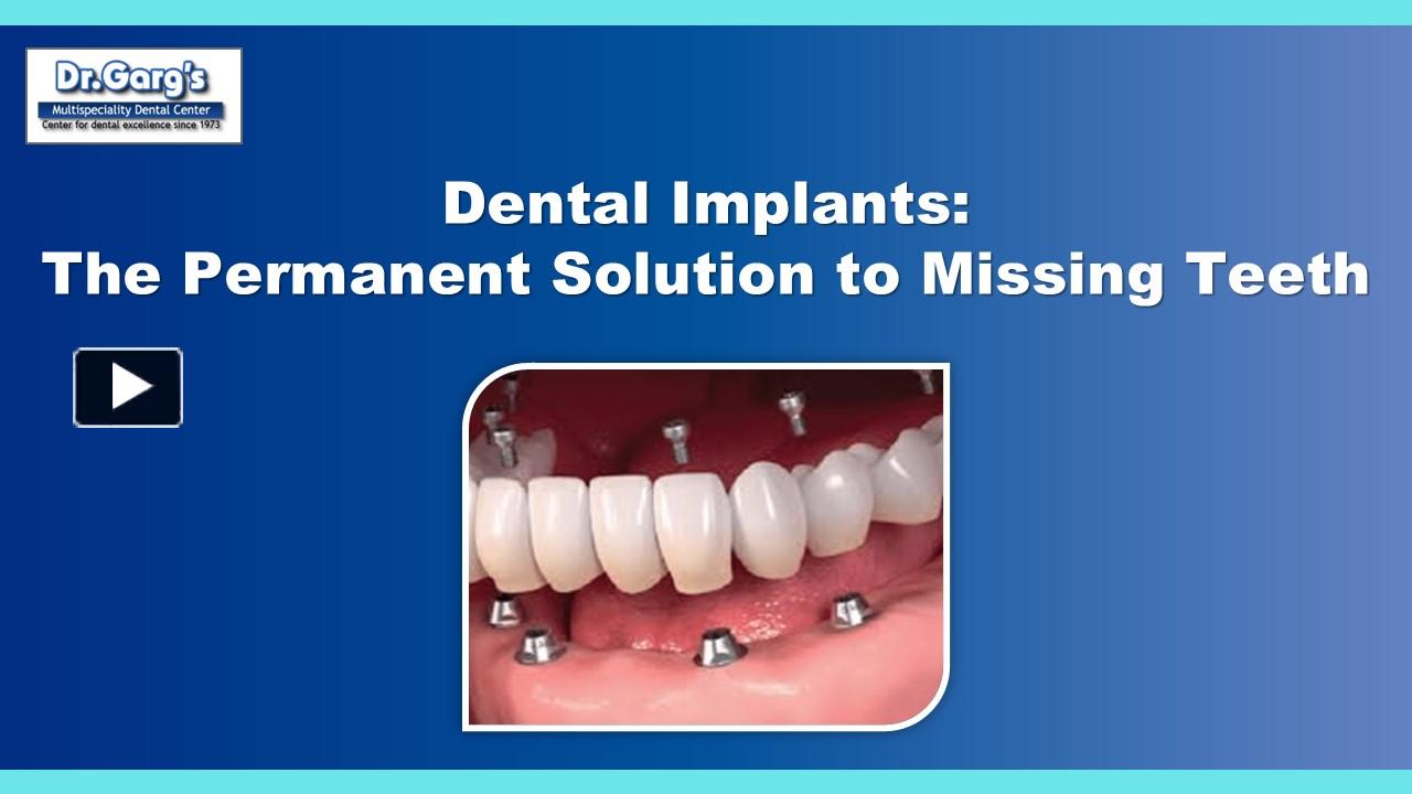 PPT – Dental Implants: The Permanent Solution to Missing Teeth PowerPoint presentation | free to ...