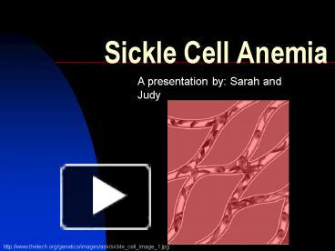 PPT – Sickle Cell Anemia PowerPoint presentation | free to view - id ...