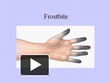 Frostbite presentation | free to download