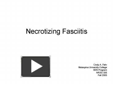 Necrotizing Fasciitis presentation | free to view