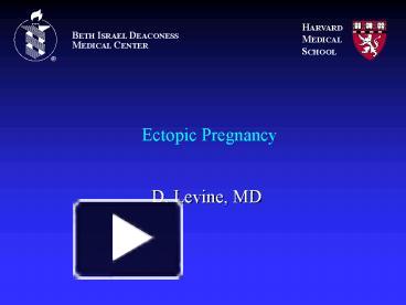 PPT – Ectopic Pregnancy PowerPoint presentation | free to view - id ...