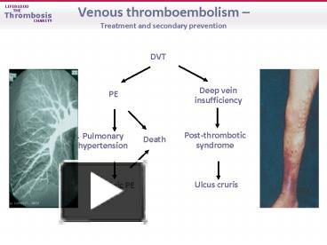 PPT – Venous thromboembolism Treatment and secondary prevention ...