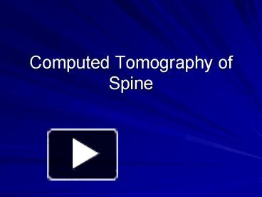 Computed Tomography of Spine presentation | free to view