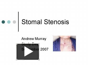 Stomal Stenosis presentation | free to view