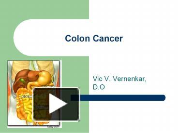 Colon Cancer presentation | free to view