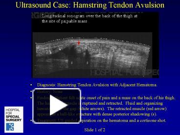 Ultrasound Case: Hamstring Tendon Avulsion presentation | free to view