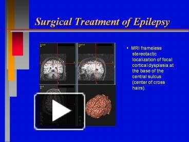PPT – Surgical Treatment of Epilepsy PowerPoint presentation | free to ...