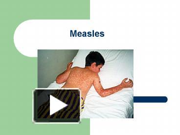 Measles presentation | free to view